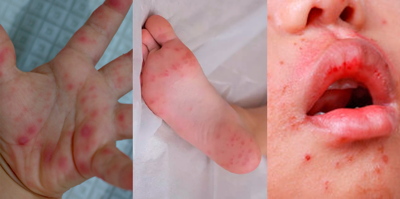 Se registra un brote del virus “manos, pies y boca” en San Nicolás ...